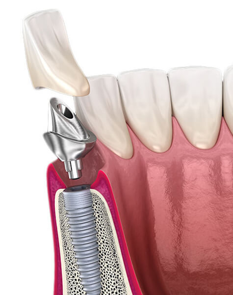 Replace missing teeth with Dental Implants in Chudleigh